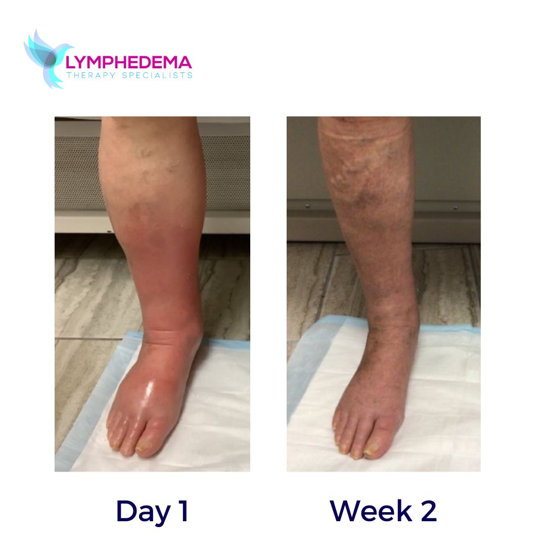 Lymphedema Therapy Specialists | Lymphedema Clinic on LinkedIn: # ... Lymphedema Therapy Specialists | Lymphedema Clinic on LinkedIn: # ...