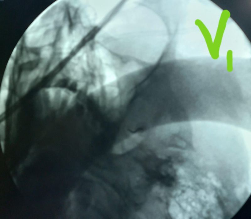 Anshul Agrawal on LinkedIn: #trigeminal #neuralgia #radiofrequency # ... Anshul Agrawal on LinkedIn: #trigeminal #neuralgia #radiofrequency # ...