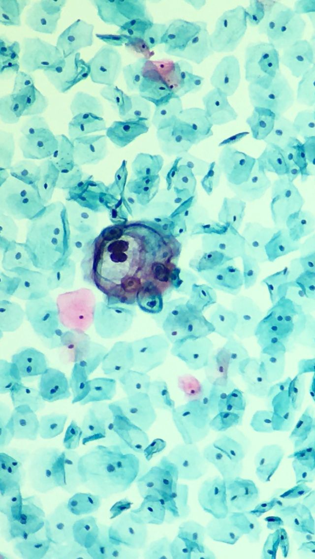 Carole Roland no LinkedIn: #koilocyte #cytodiagnostic #cytotech #anapath Carole Roland no LinkedIn: #koilocyte #cytodiagnostic #cytotech #anapath