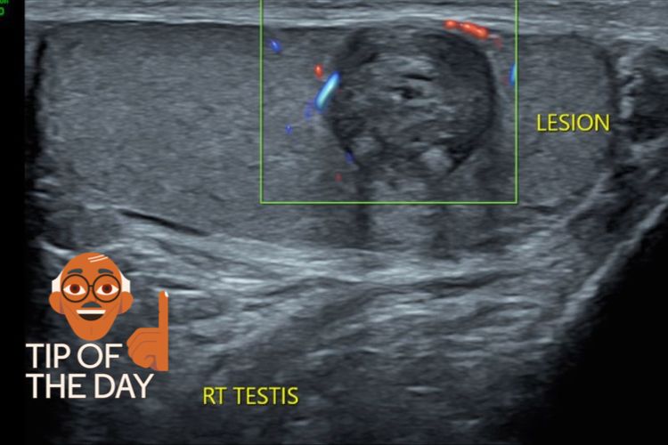 Mohamed Shemais on LinkedIn: #radiology #medicine #testiculartumors # ... Mohamed Shemais on LinkedIn: #radiology #medicine #testiculartumors # ...