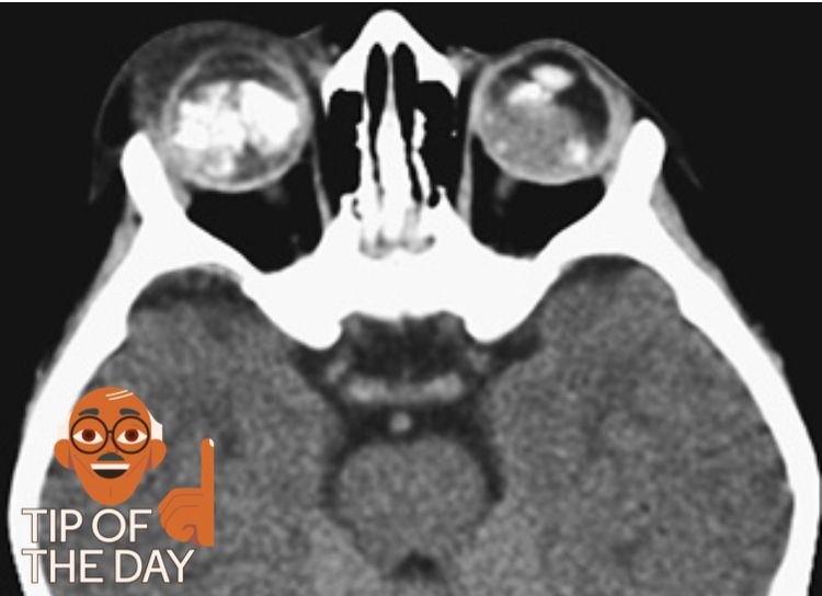 Mohamed Shemais on LinkedIn: #retinoblastoma #radiology #keeplearning # ... Mohamed Shemais on LinkedIn: #retinoblastoma #radiology #keeplearning # ...