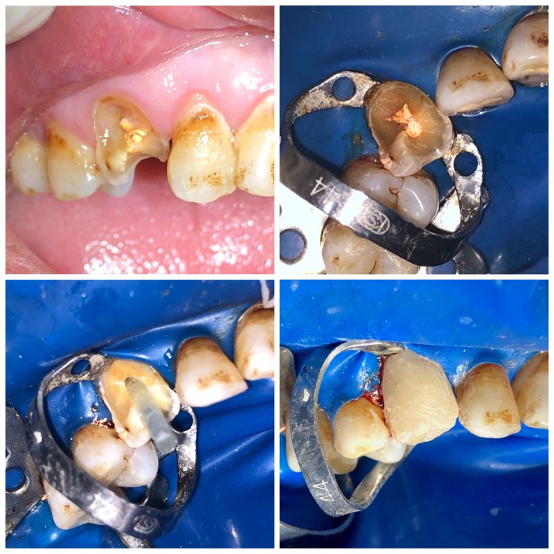 Post and Core Buildup. | Mostafa Hattab Post and Core Buildup. | Mostafa Hattab