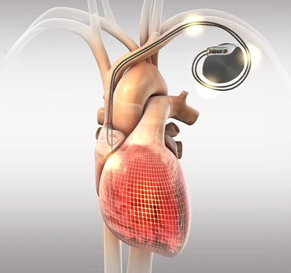 Jeffrey Williams MD MS FACC FHRS CPE HF-Cert on LinkedIn: Pacemaker ... Jeffrey Williams MD MS FACC FHRS CPE HF-Cert on LinkedIn: Pacemaker ...