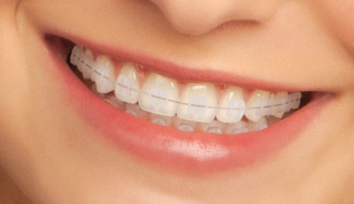 Orthodontic Supplies Market 2023 New Research Study Orthodontic Supplies Market 2023 New Research Study
