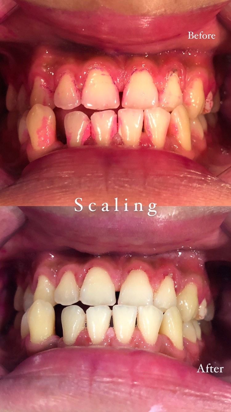 Dr. Nur Alyssa on LinkedIn: A typical scaling day Dr. Nur Alyssa on LinkedIn: A typical scaling day