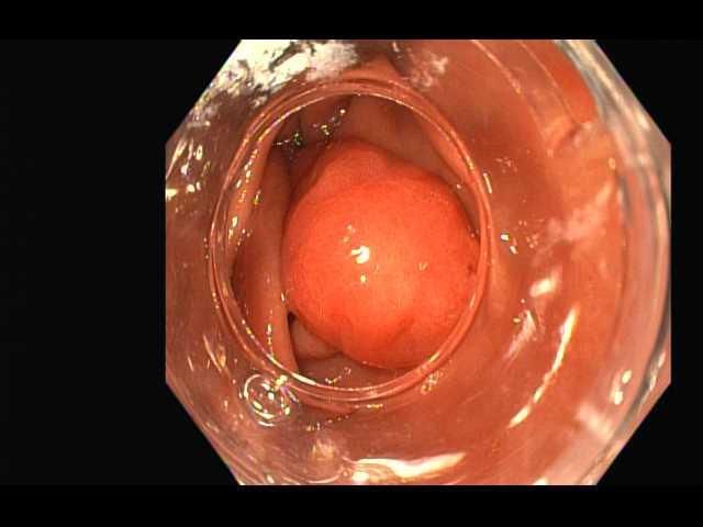 Antonio Mendoza Ladd MD, AGAF, FACG, FASGE on LinkedIn: Endoscopic ... Antonio Mendoza Ladd MD, AGAF, FACG, FASGE on LinkedIn: Endoscopic ...