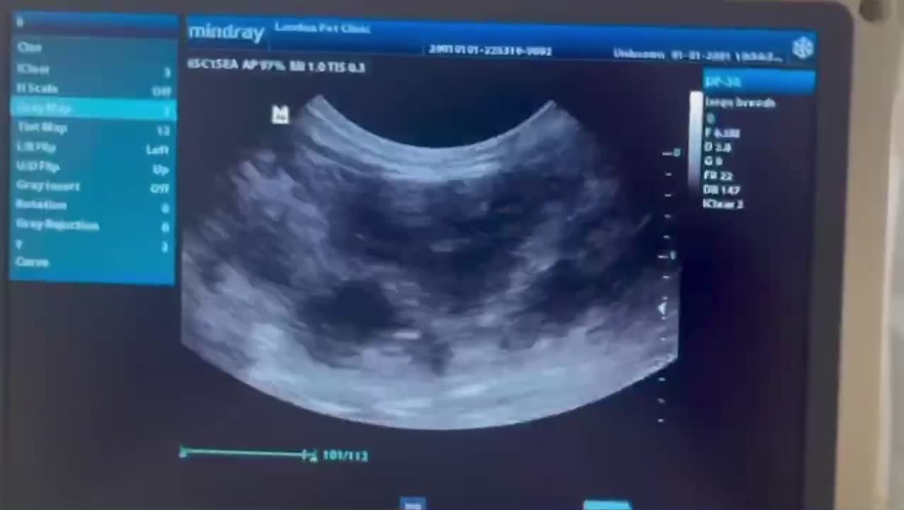 Yasmeen Sameh on LinkedIn: Silent case of PCK (poly cystic kidney) a ... Yasmeen Sameh on LinkedIn: Silent case of PCK (poly cystic kidney) a ...