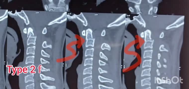 Sagar Sharma on LinkedIn: #spine #spinesurgery #minimallyinvasivesurgery… Sagar Sharma on LinkedIn: #spine #spinesurgery #minimallyinvasivesurgery…