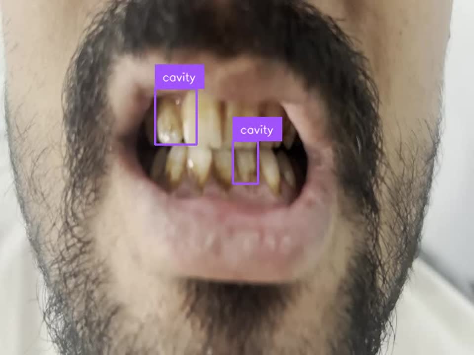 Noor khokhar on LinkedIn: #dentalai #yolov11 #healthcareinnovation # ... Noor khokhar on LinkedIn: #dentalai #yolov11 #healthcareinnovation # ...