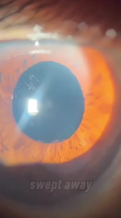 Uswa Fatima on LinkedIn: Aphakic case along with trauma history Uswa Fatima on LinkedIn: Aphakic case along with trauma history