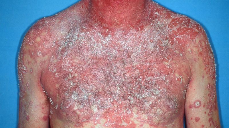 Juan Carlos Ivancevich on LinkedIn: Why Did Older Man Develop Itchy ... Juan Carlos Ivancevich on LinkedIn: Why Did Older Man Develop Itchy ...