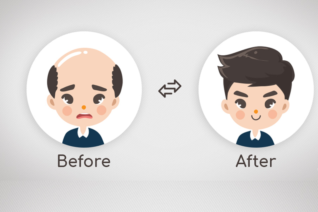 Vplant Advance Hair - Best Hair Transplant Clinic in India Vplant Advance Hair - Best Hair Transplant Clinic in India