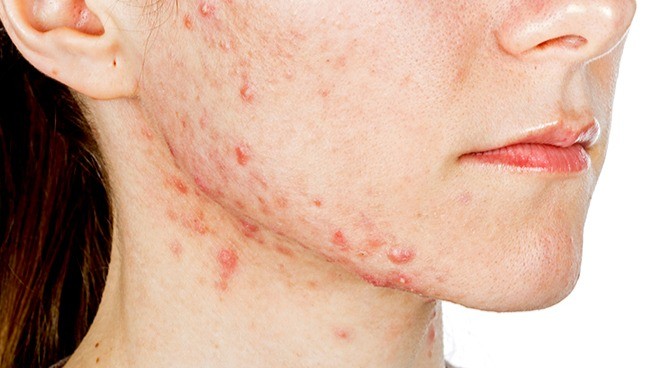 Tranexamic acid Vs. Vitamin C microneedling in post-acne Tranexamic acid Vs. Vitamin C microneedling in post-acne