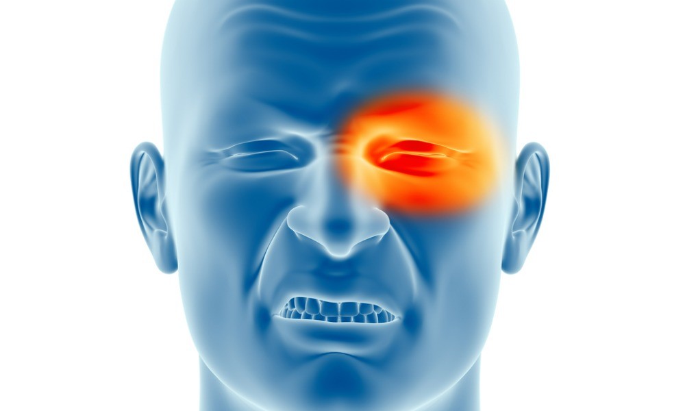Managing Cluster Headaches: A Comprehensive Guide to Remedies and ... Managing Cluster Headaches: A Comprehensive Guide to Remedies and ...
