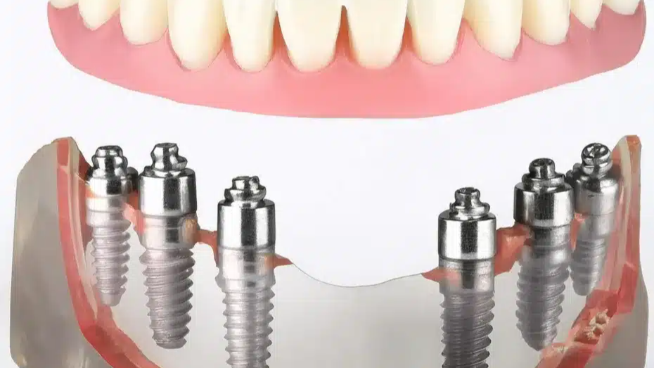 🦷 Transforming Smiles: The All-on-6 Dental Implant Journey 🦷 Transforming Smiles: The All-on-6 Dental Implant Journey