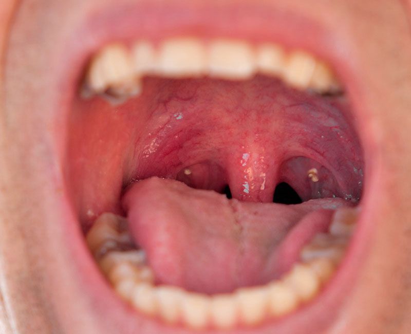 Sagar Rajkuwar on LinkedIn: #tonsillitis #white #white Sagar Rajkuwar on LinkedIn: #tonsillitis #white #white