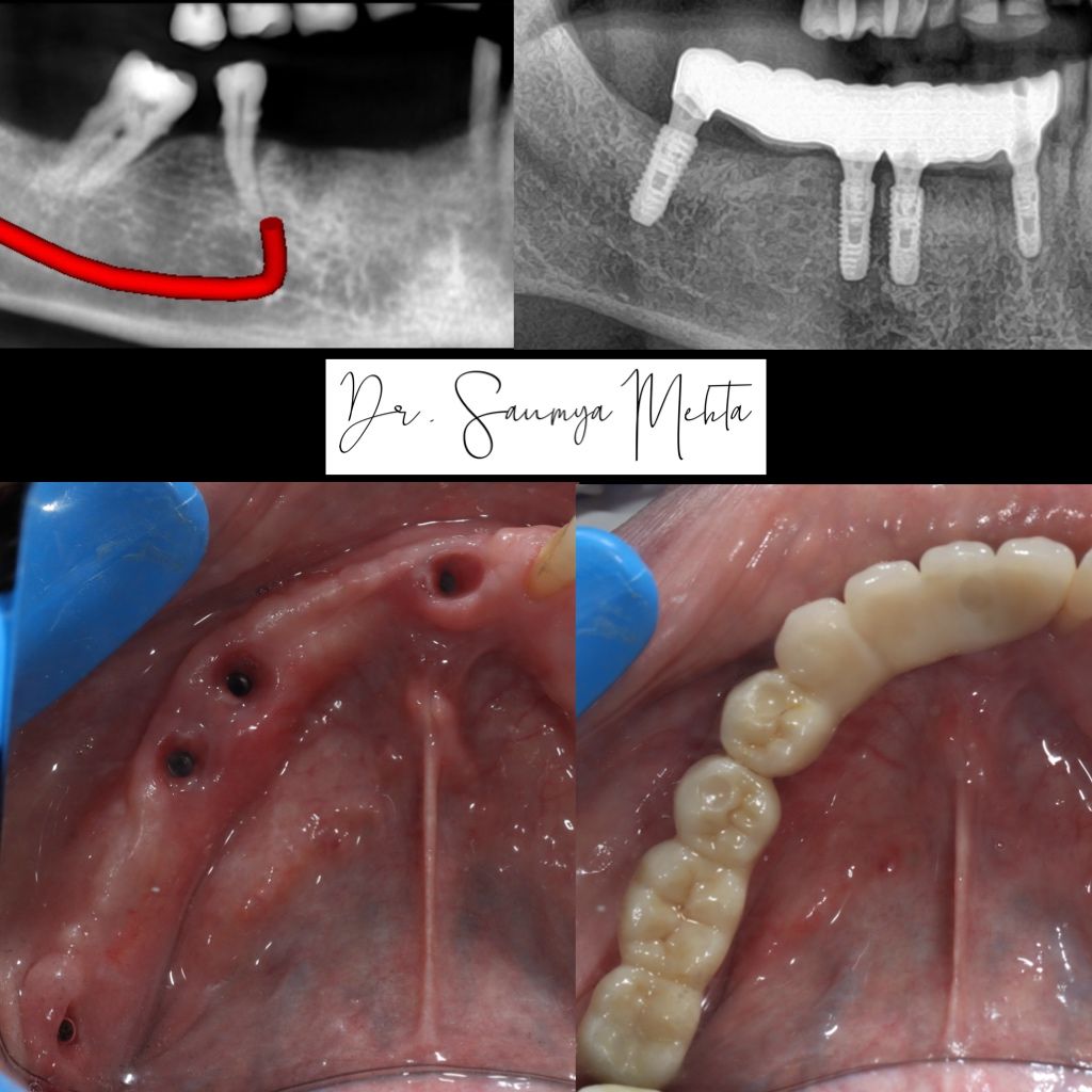 Free hand placement done with #osstem implants! | Dr Saumya Mehta ... Free hand placement done with #osstem implants! | Dr Saumya Mehta ...