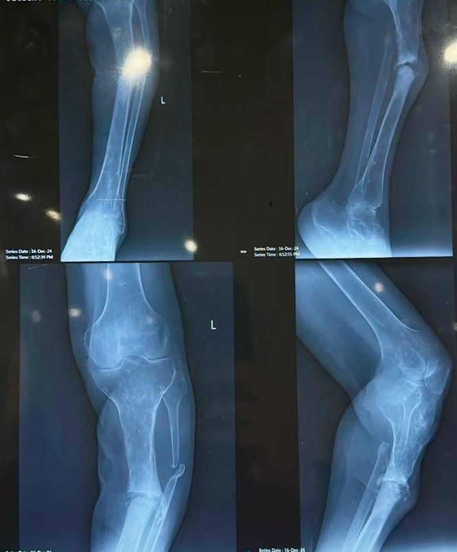 Dr Muhammad Haseeb on LinkedIn: #ortho Dr Muhammad Haseeb on LinkedIn: #ortho