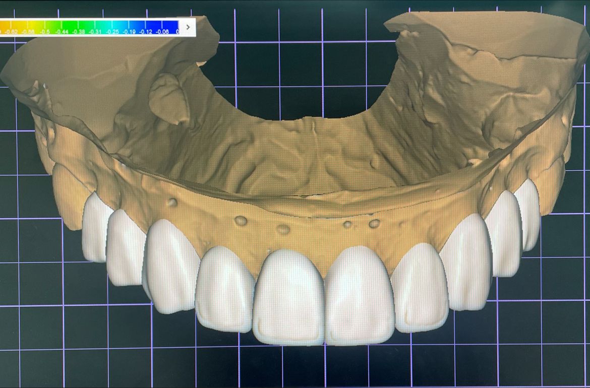 Shaijal Salahudheen muhammed on LinkedIn: Veneers with minimal trans Shaijal Salahudheen muhammed on LinkedIn: Veneers with minimal trans