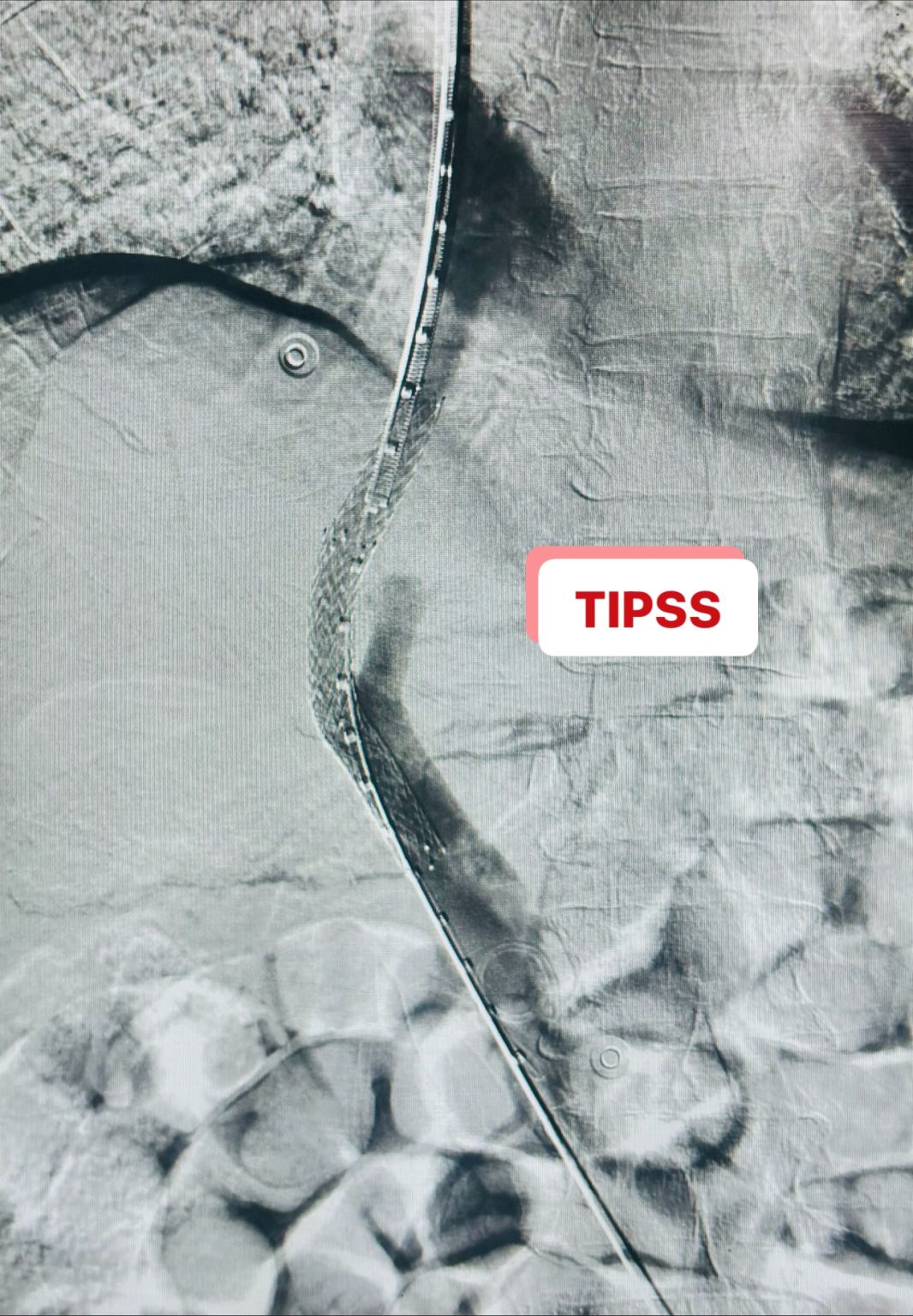 Harish Bhujade on LinkedIn: #interventional #pgimer #tipss #dipss # ... Harish Bhujade on LinkedIn: #interventional #pgimer #tipss #dipss # ...