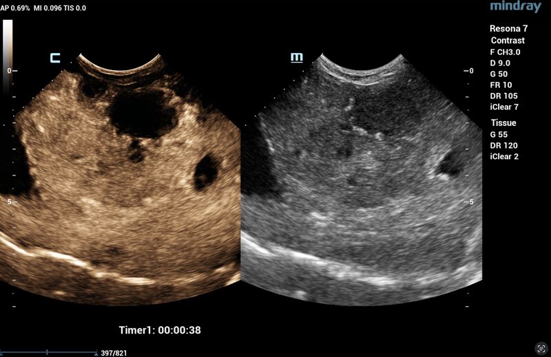 Giuseppe Rubini on LinkedIn: A liver mass is detected on the basic US ... Giuseppe Rubini on LinkedIn: A liver mass is detected on the basic US ...