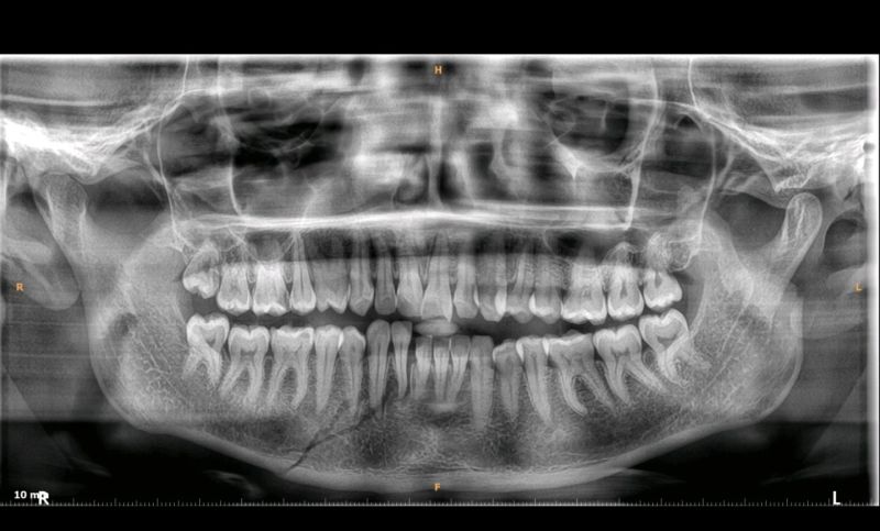 mandibular fractures - parasymphysis and condyle Condylar fractures ... mandibular fractures - parasymphysis and condyle Condylar fractures ...
