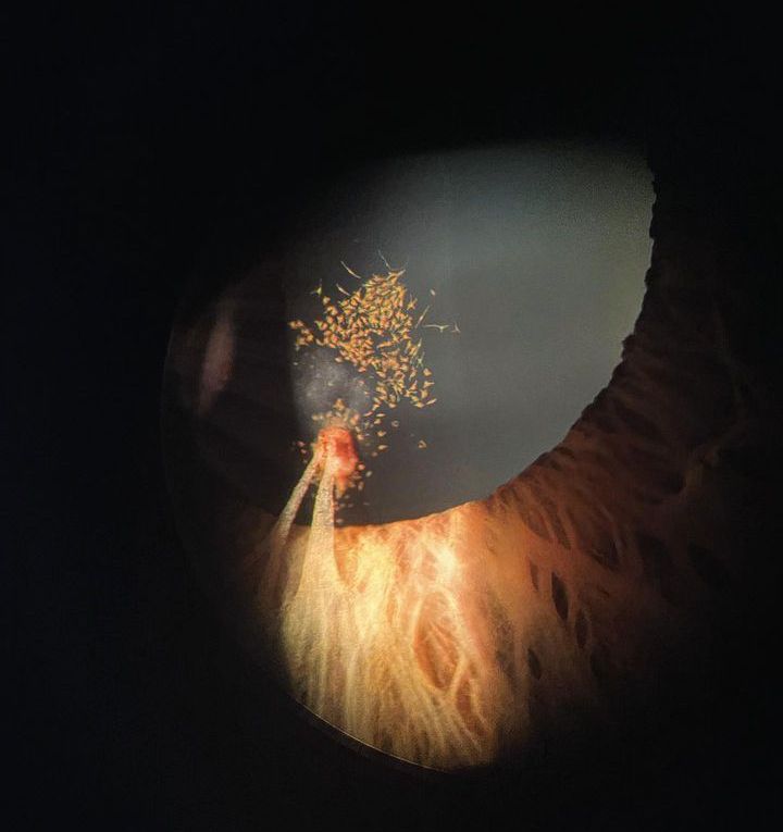 Satyam Jha on LinkedIn: 🔴 A Very Unique Persistent Pupillary Membrane ... Satyam Jha on LinkedIn: 🔴 A Very Unique Persistent Pupillary Membrane ...