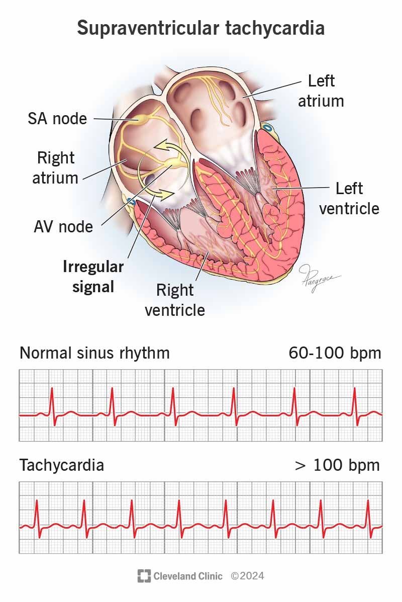 Owais Mohammad Ahmad on LinkedIn: Supraventricular arrhythmias = Any ... Owais Mohammad Ahmad on LinkedIn: Supraventricular arrhythmias = Any ...