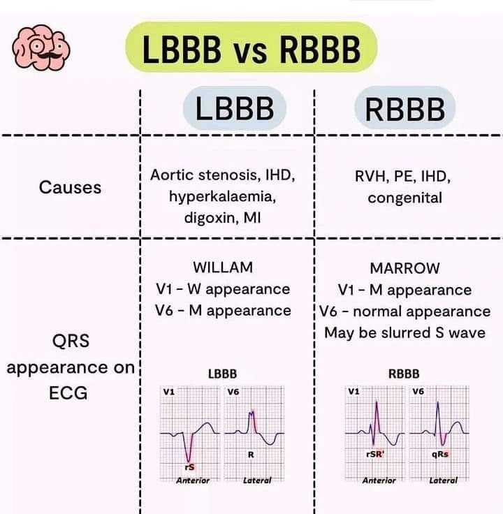safa gul on LinkedIn: ECG INTERPRETATION OF BUNDLE BRANCH BLOCKS safa gul on LinkedIn: ECG INTERPRETATION OF BUNDLE BRANCH BLOCKS