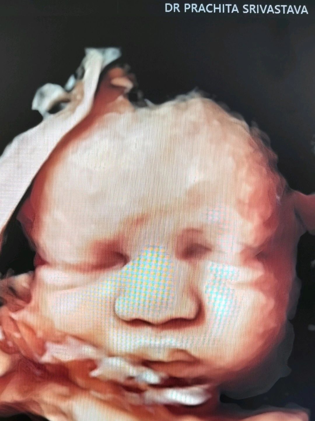 Dr.Prachita Srivastava on LinkedIn: #fetalmedicine #fetalultrasound ... Dr.Prachita Srivastava on LinkedIn: #fetalmedicine #fetalultrasound ...