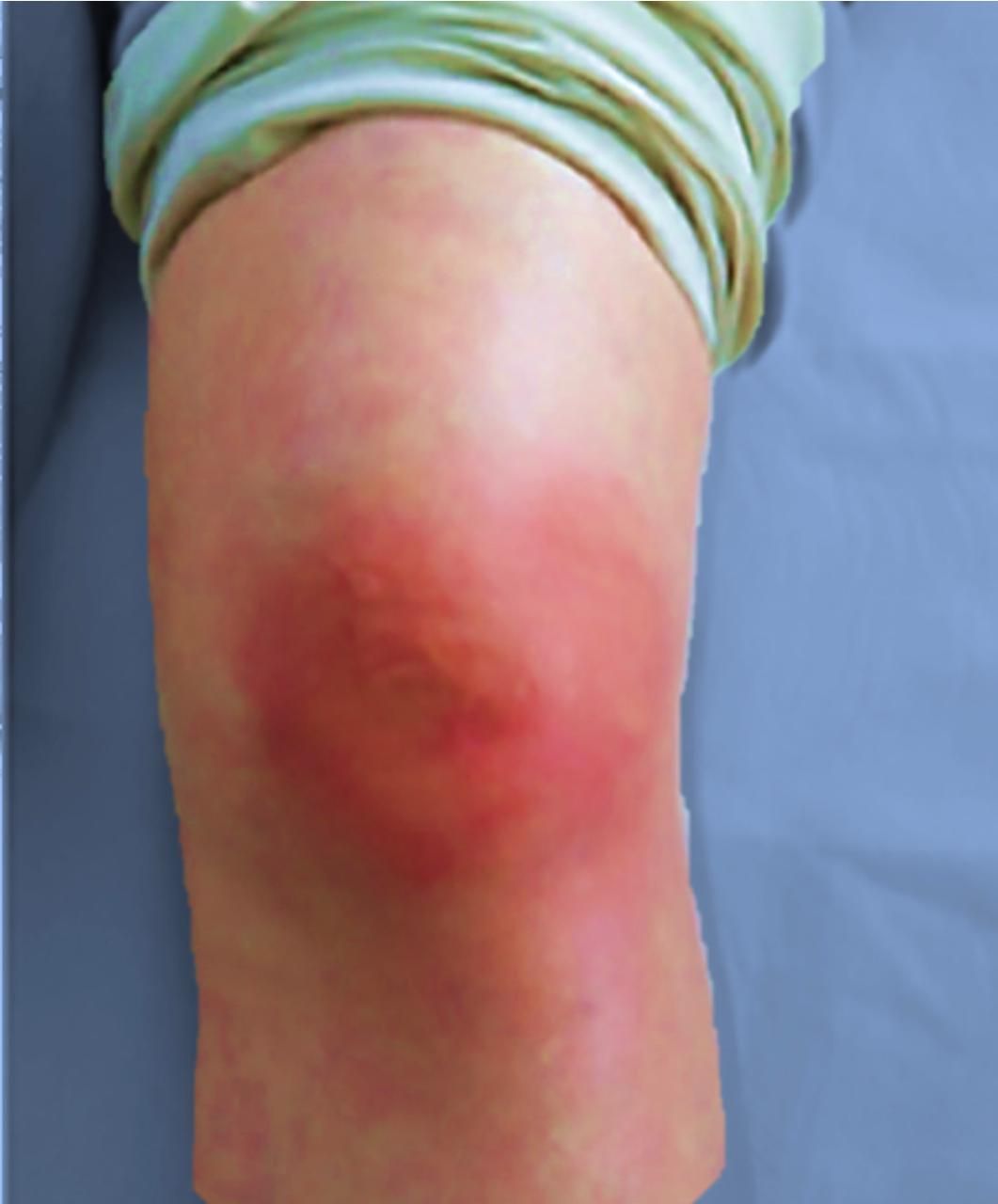 Dr.Zehra Jaffar on LinkedIn: Some important points on Septic arthritis ... Dr.Zehra Jaffar on LinkedIn: Some important points on Septic arthritis ...