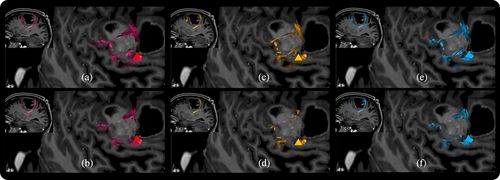 #ntms #neurosurgery #radiotherapy #brainmapping #brainplasticity | Nexstim #ntms #neurosurgery #radiotherapy #brainmapping #brainplasticity | Nexstim