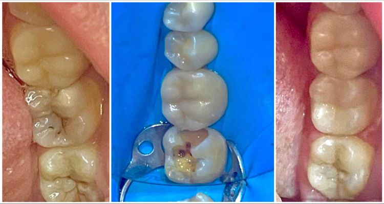 Omar Abd elaziz on LinkedIn: Composite restoration of LL7 Omar Abd elaziz on LinkedIn: Composite restoration of LL7