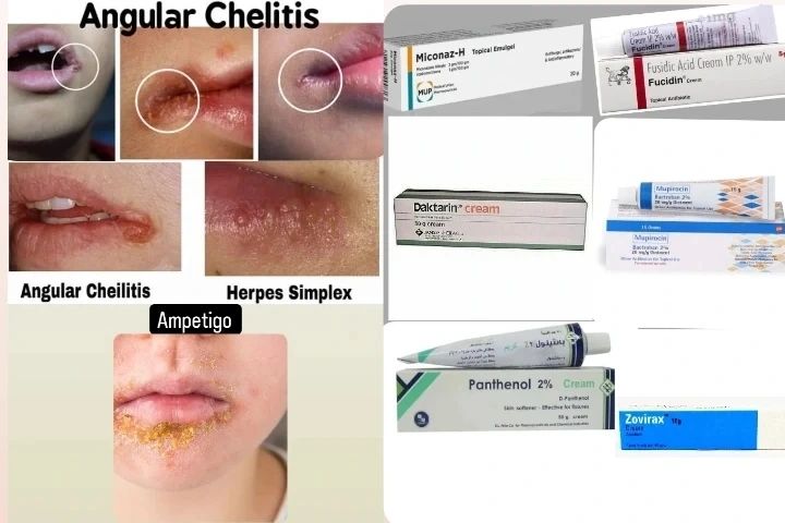 Salma Elsaeed Elsayed on LinkedIn: Difference between Angular cheilitis ... Salma Elsaeed Elsayed on LinkedIn: Difference between Angular cheilitis ...