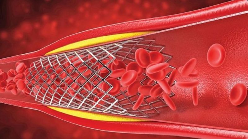No Clear Advantage of Ticagrelor vs. Clopidogrel in Complex PCI for ... No Clear Advantage of Ticagrelor vs. Clopidogrel in Complex PCI for ...