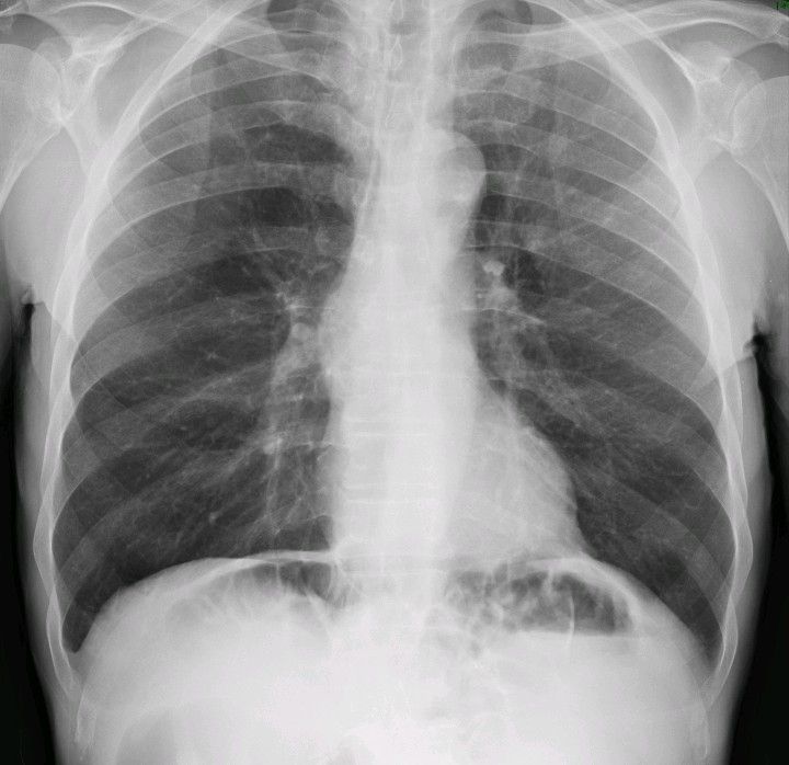 Owais Aleter on LinkedIn: 60 y male chiliaditi sign interposition of ... Owais Aleter on LinkedIn: 60 y male chiliaditi sign interposition of ...