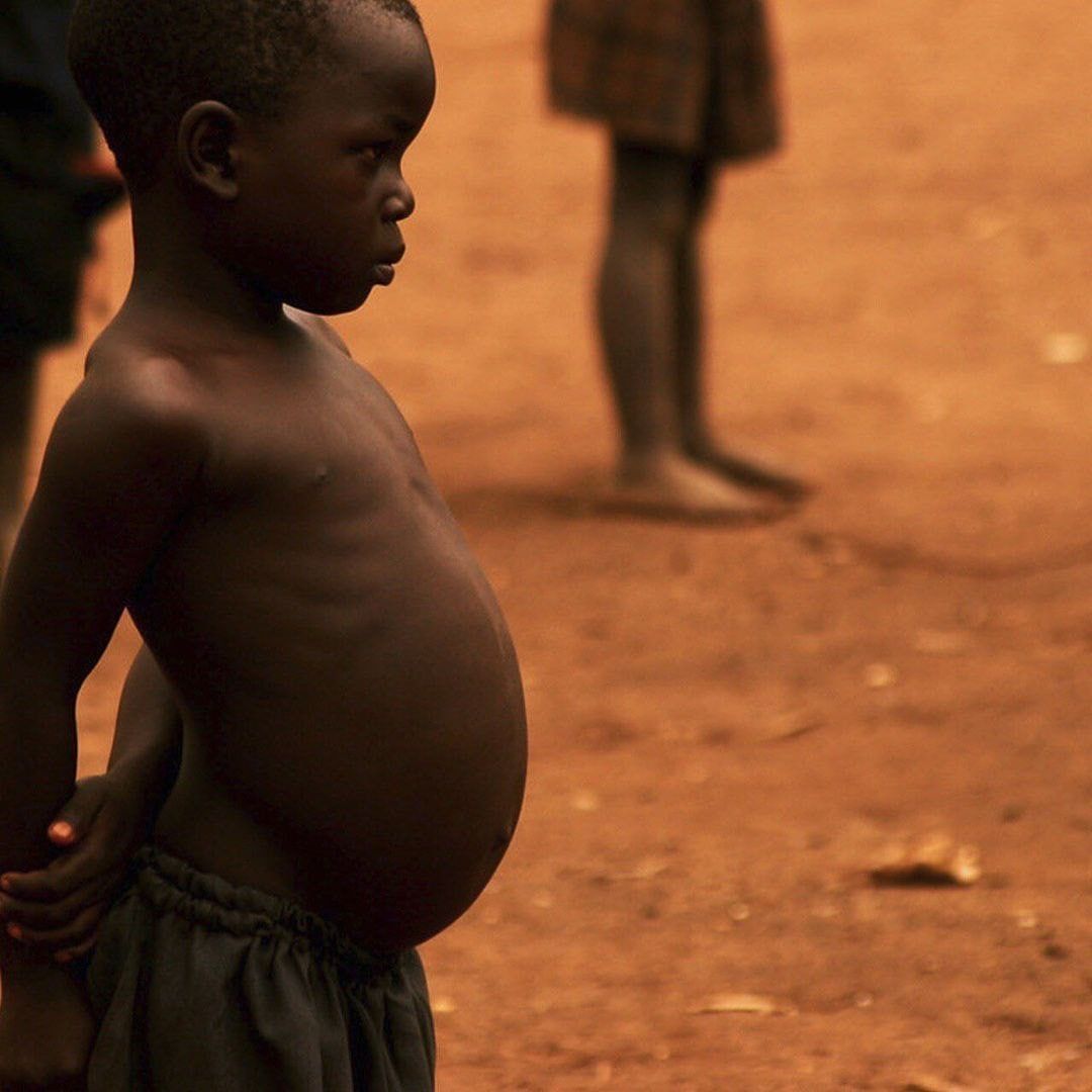 Dr. Shashikant Singh on LinkedIn: #kwashiorkor Dr. Shashikant Singh on LinkedIn: #kwashiorkor