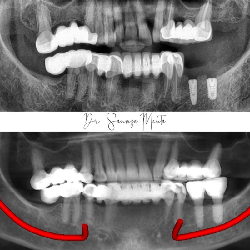Implant placement with respect to 36 and 37, followed by zirconia… | Dr ... Implant placement with respect to 36 and 37, followed by zirconia… | Dr ...