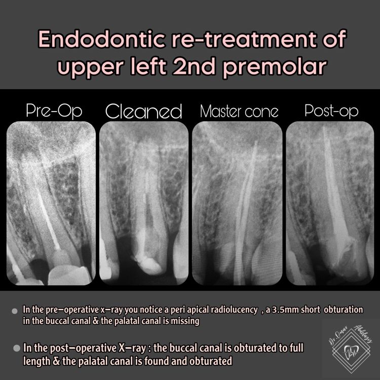 Omar Abd elaziz on LinkedIn: Case of the day Patient came to the clinic ... Omar Abd elaziz on LinkedIn: Case of the day Patient came to the clinic ...