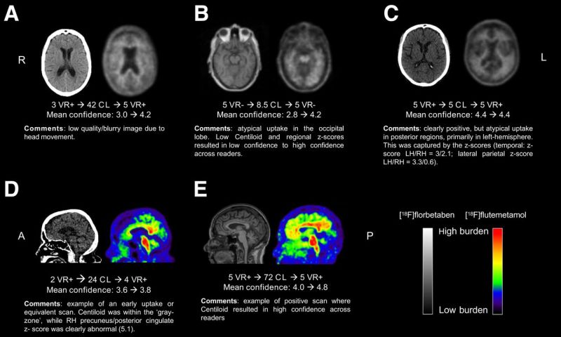 Quantification Supports Amyloid PET Visual Assessment of Challenging ... Quantification Supports Amyloid PET Visual Assessment of Challenging ...