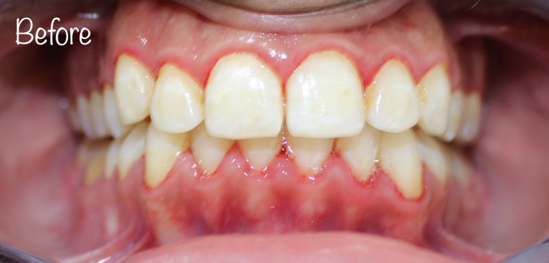 saud wadaah on LinkedIn: Patient CC: My gum bleeding every time and i ... saud wadaah on LinkedIn: Patient CC: My gum bleeding every time and i ...