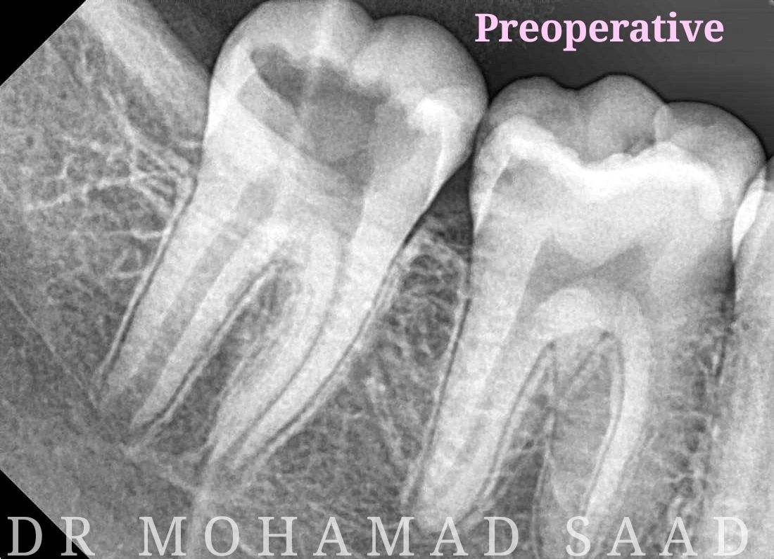Dr. Mohamad Saad AbdElkhalek PhD on LinkedIn: Recently erupted immature ... Dr. Mohamad Saad AbdElkhalek PhD on LinkedIn: Recently erupted immature ...
