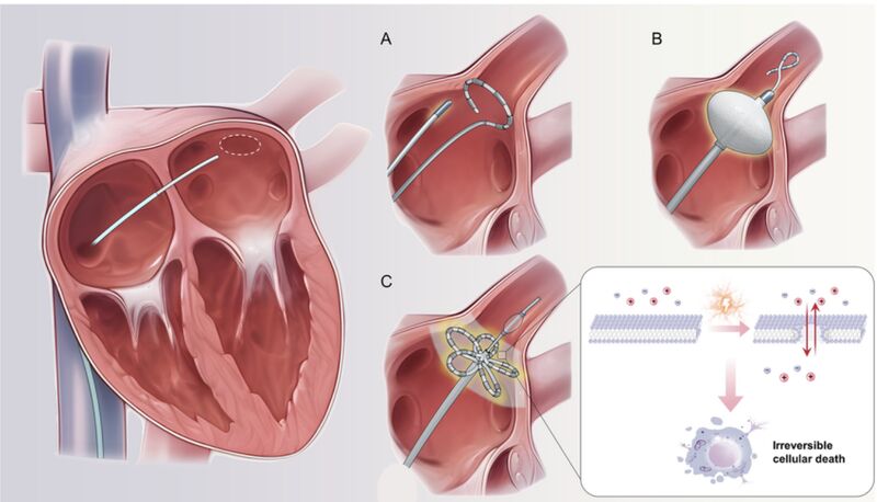 Dr. Ashraf Hussein على LinkedIn: #cryoballoon #radiofrequency #atrial # ... Dr. Ashraf Hussein على LinkedIn: #cryoballoon #radiofrequency #atrial # ...