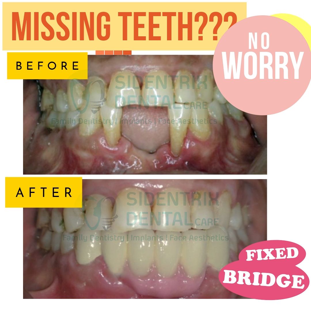 Dr. Siddhesh Borse on LinkedIn: #dentalinnovation #smiletransformation ... Dr. Siddhesh Borse on LinkedIn: #dentalinnovation #smiletransformation ...