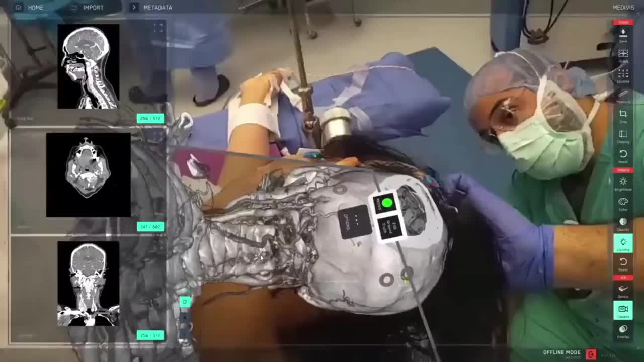 Shruti Patel on LinkedIn: #surgicalinnovation #augmentedreality # ... Shruti Patel on LinkedIn: #surgicalinnovation #augmentedreality # ...