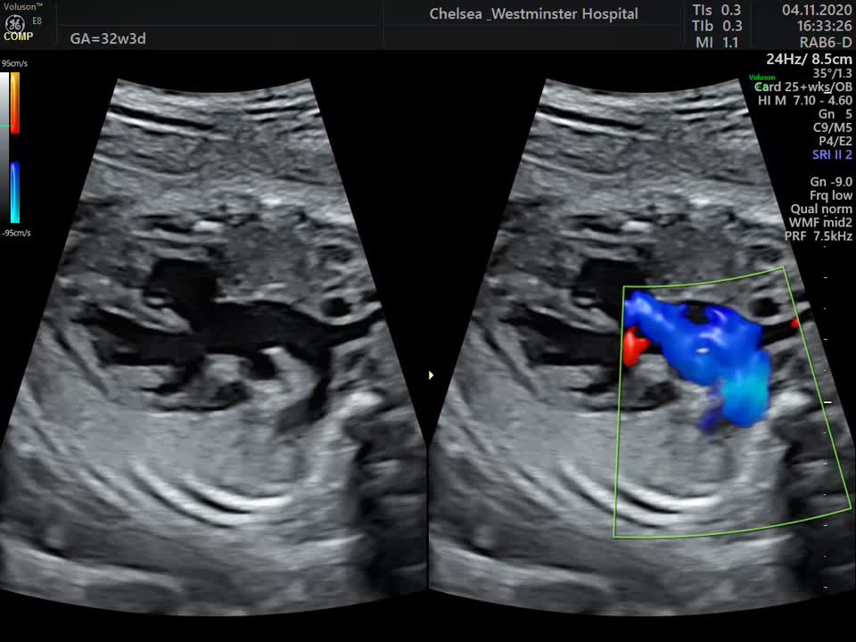 Muhammad Hashim Khan on LinkedIn: Truncus Arteriosus Type 1 Muhammad Hashim Khan on LinkedIn: Truncus Arteriosus Type 1