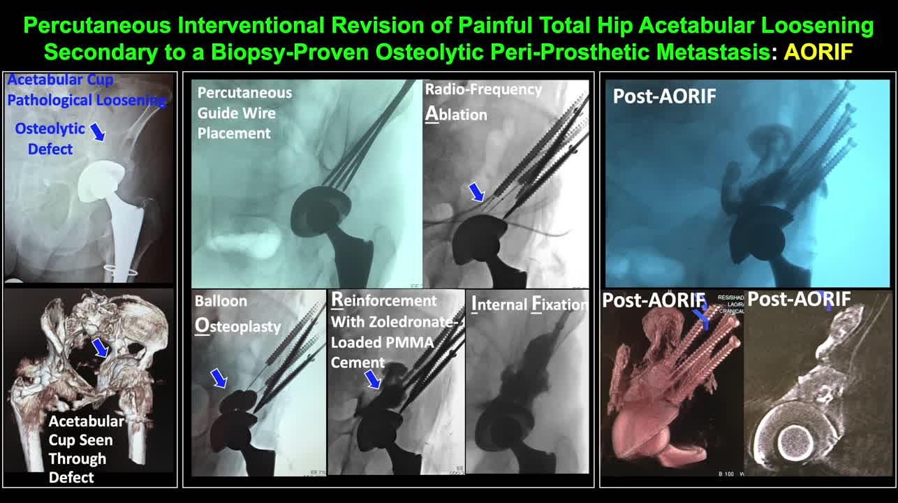 Francis Y. Lee, M.D., Ph.D. on LinkedIn: #revisionarthroplasty # ... Francis Y. Lee, M.D., Ph.D. on LinkedIn: #revisionarthroplasty # ...