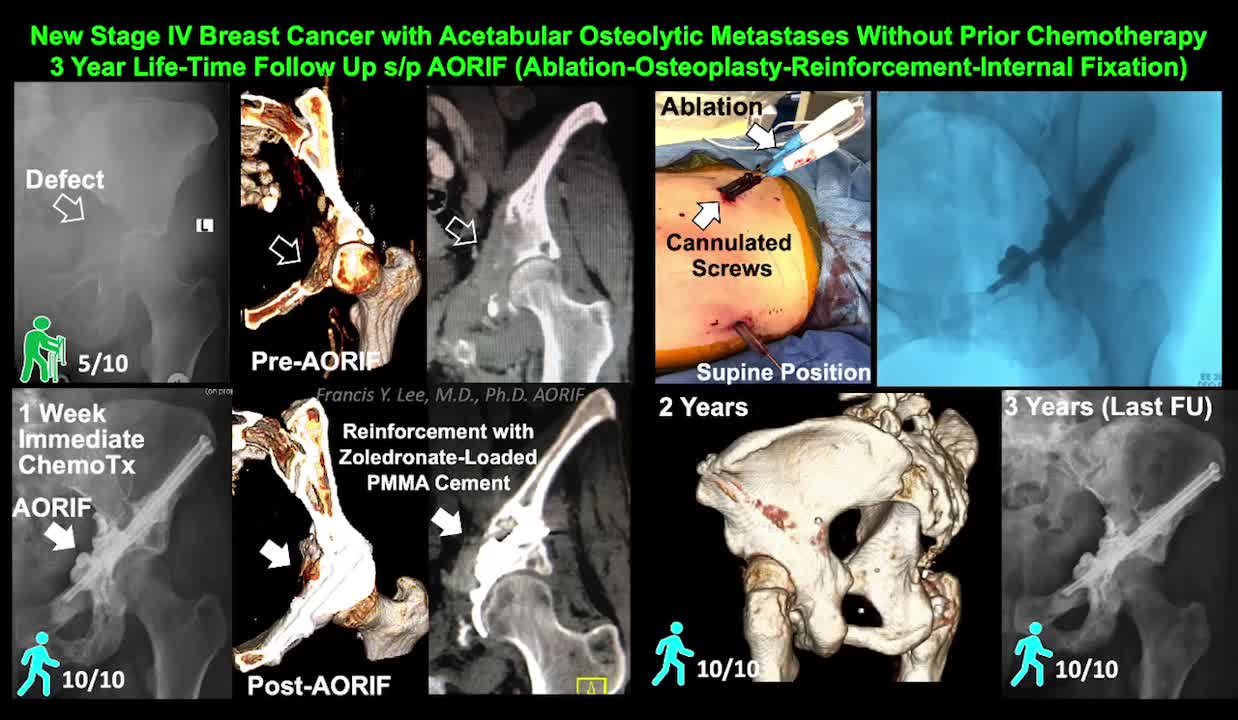 Francis Y. Lee, M.D., Ph.D. on LinkedIn: #minimallyinvasive #hip # ... Francis Y. Lee, M.D., Ph.D. on LinkedIn: #minimallyinvasive #hip # ...