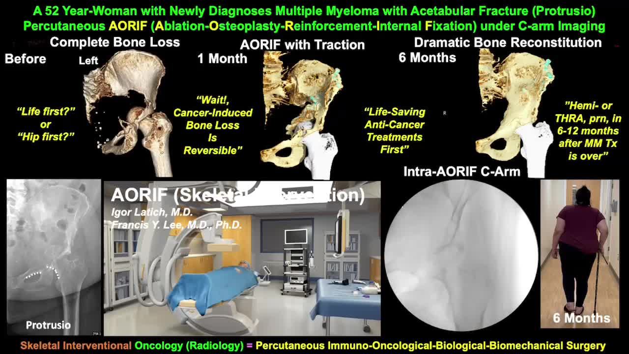 Francis Y. Lee, M.D., Ph.D. on LinkedIn: #skeletalintervention Francis Y. Lee, M.D., Ph.D. on LinkedIn: #skeletalintervention