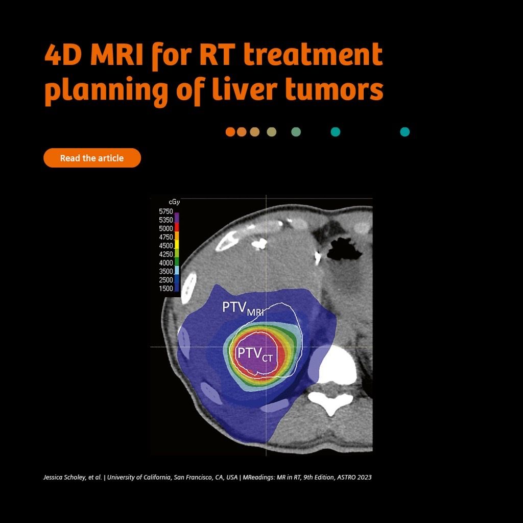 Siemens Healthineers on LinkedIn: 4D MRI for Treatment Planning of ... Siemens Healthineers on LinkedIn: 4D MRI for Treatment Planning of ...